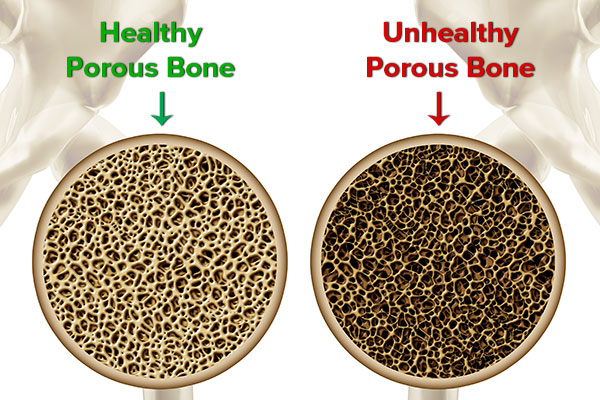 Osteoporosis vs. Osteopenia vs. Osteoarthritis: The Signs, Symptoms ... Osteoporosis vs. Osteopenia vs. Osteoarthritis: The Signs, Symptoms ...